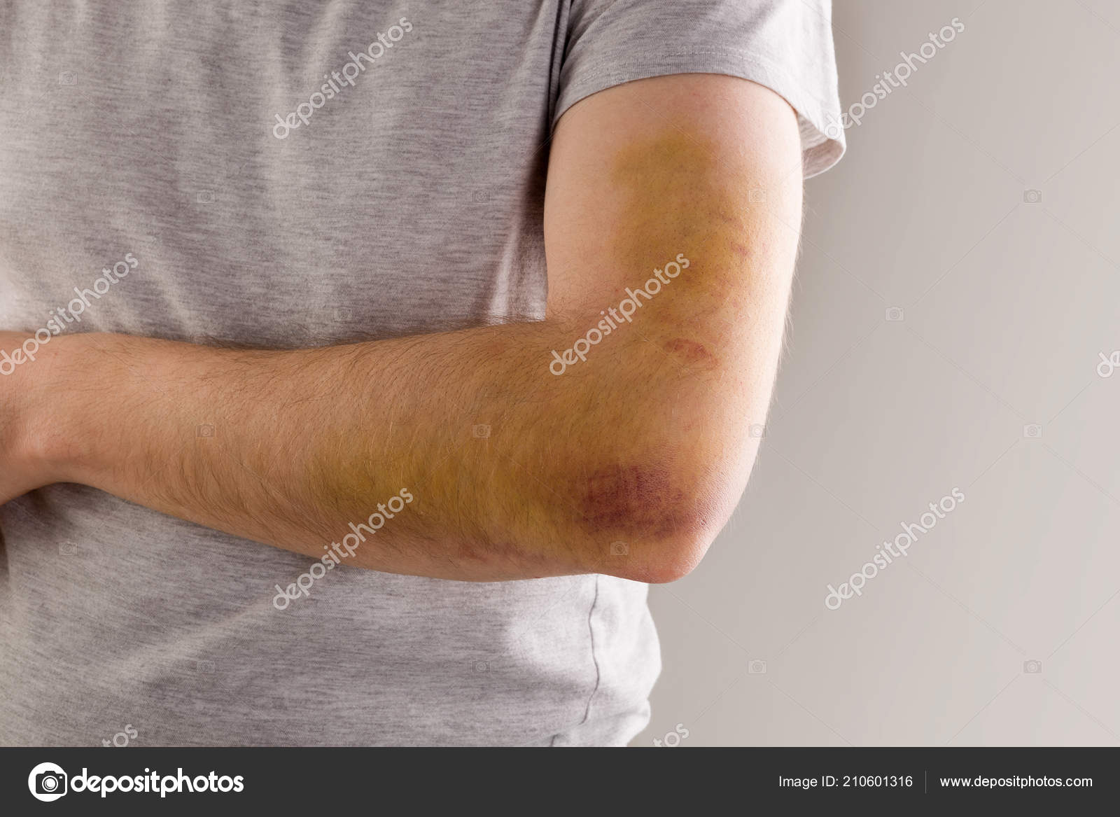 Handsome Man Big Bruise Forearm Elbow Arm Sport Injury ⬇ Stock Photo ...