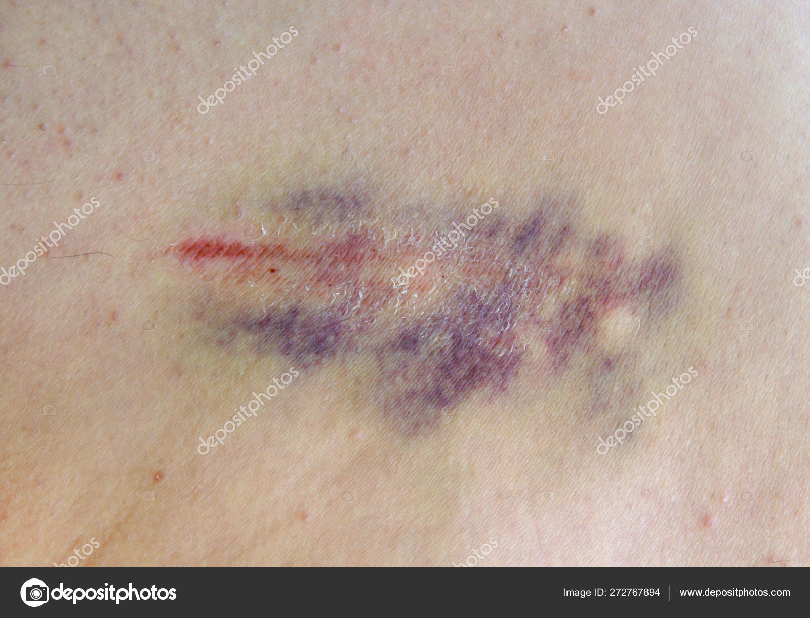 Hematoma de tejido — Foto de stock #272767894 © V_Nikitenko
