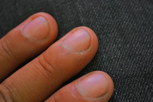 Scabs Stock Photos, Royalty Free Scabs Images | Depositphotos