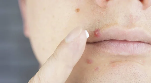 Herpes Or Pimple On Chin
