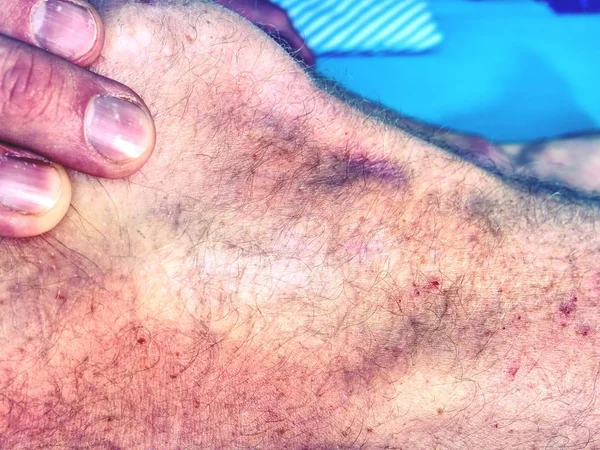 Herida contusionada en cuerpo humano. Paciente muestra cuerpo lesionado ...