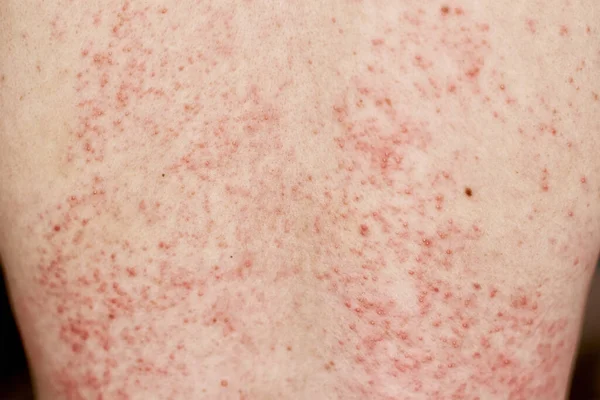 Erythematous Rash