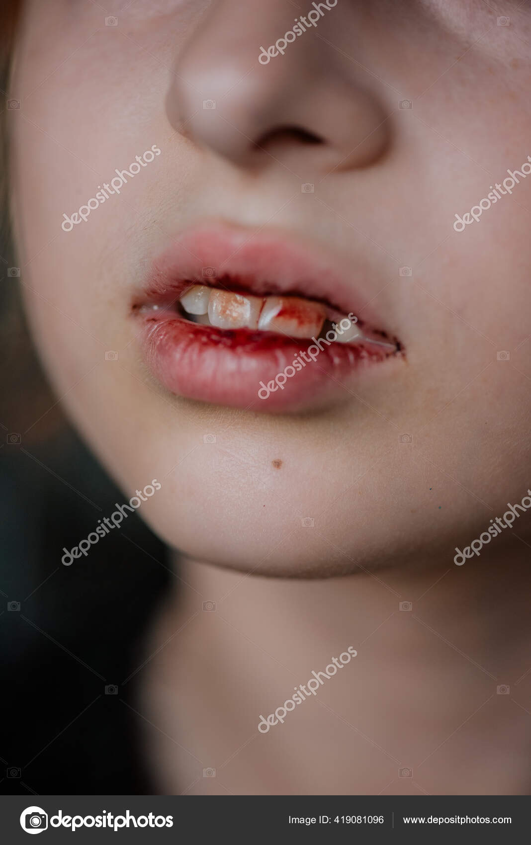 Niña Con Labio Roto Una Chica Con Labio Roto Adolescente: fotografía de ...