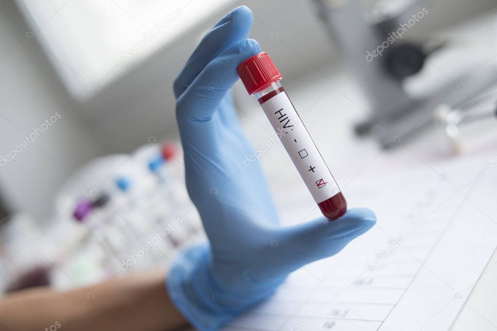 Diagnóstico sosteniendo en la mano una prueba positiva del VIH. 2025
