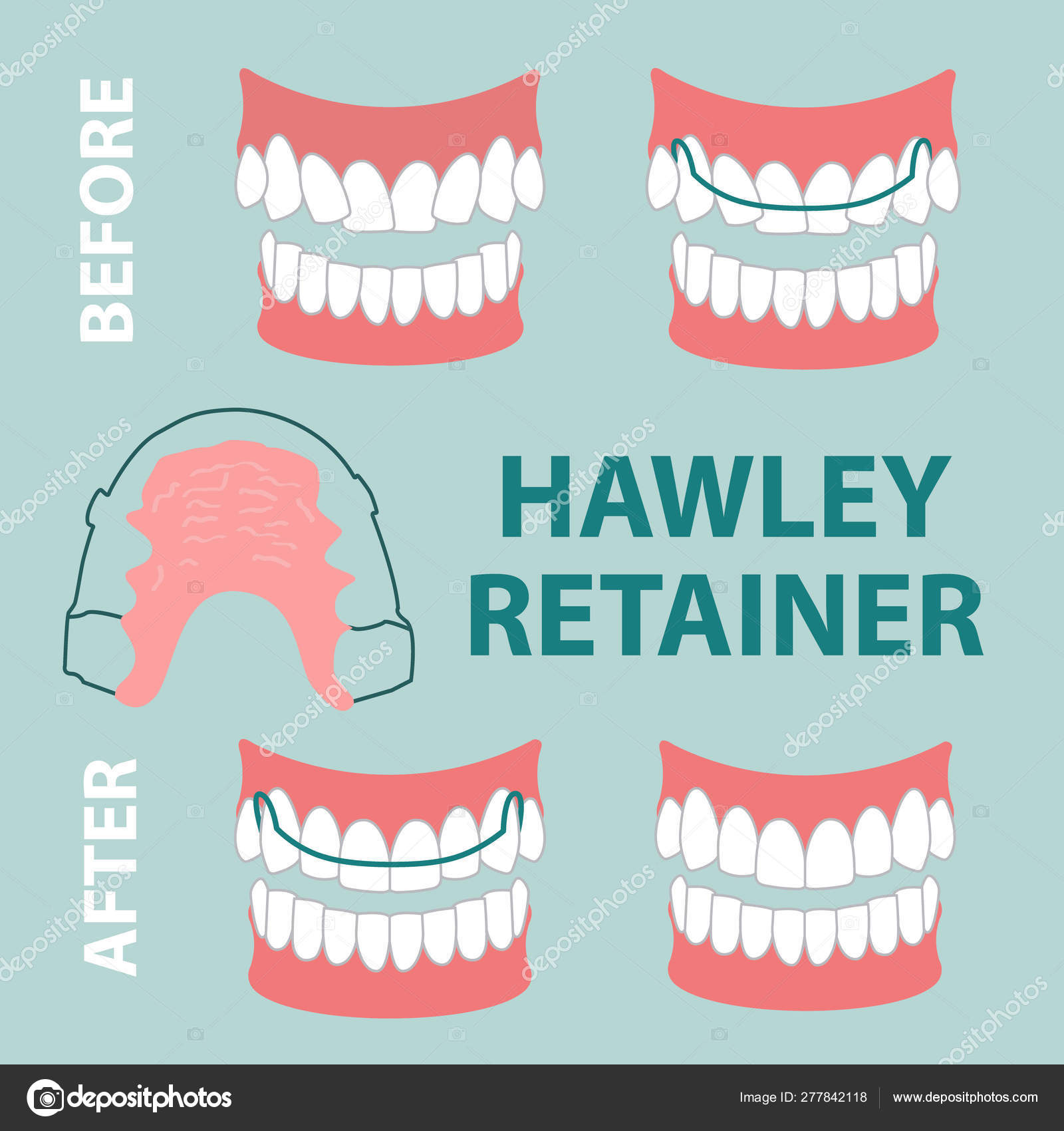 Vector Illustration Hawley Retainer Stock Vector Image by ©Mariia206 ...