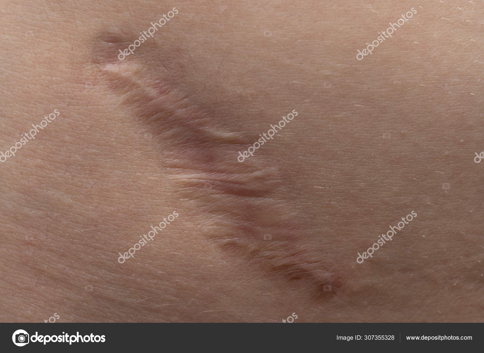 Macro photo of the young human's scar texture — Stock Photo ...