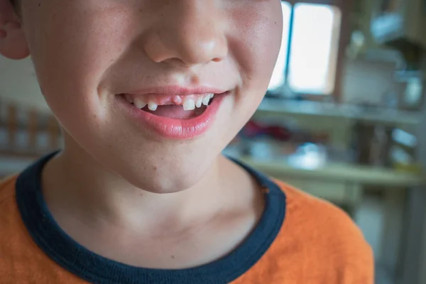Child missing teeth Pictures, Child missing teeth Stock Photos & Images ...