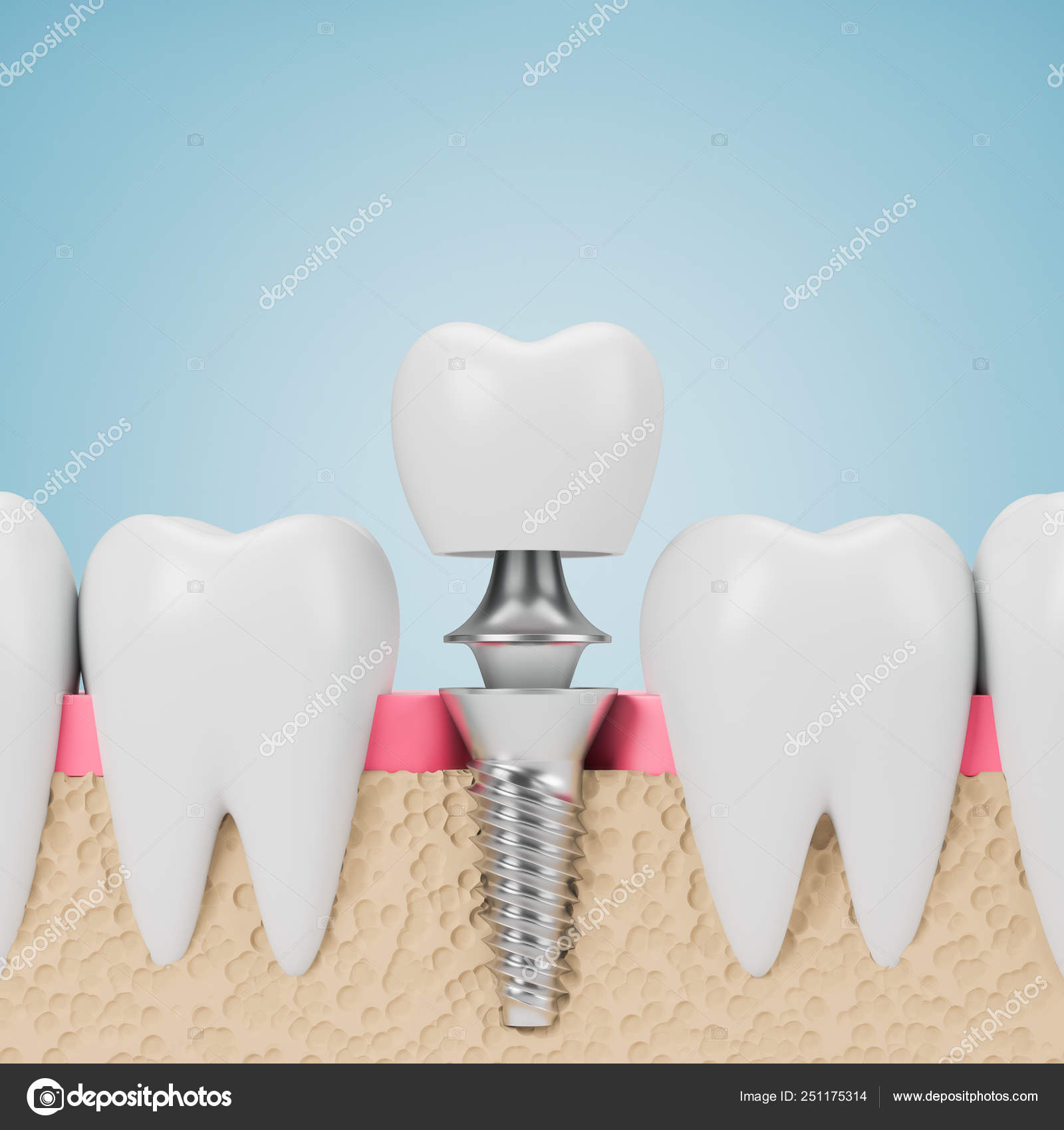 Teeth with implant screw, blue background Stock Photo by ...