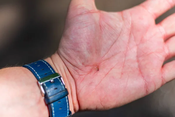 Puncture wound Stock Photos, Royalty Free Puncture wound Images ...