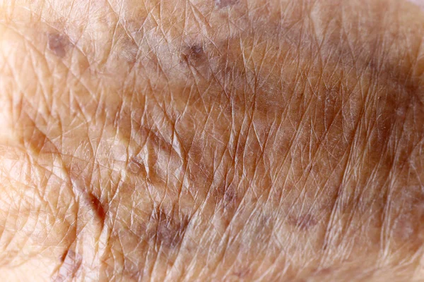 Skin atrophy Stock Photos, Royalty Free Skin atrophy Images | Depositphotos