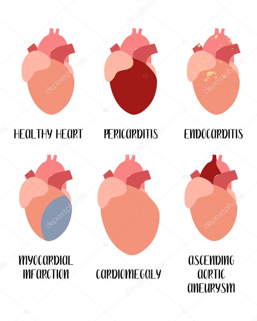 Corazón, enfermedades cardiovasculares. Pericarditis, endocarditis ...