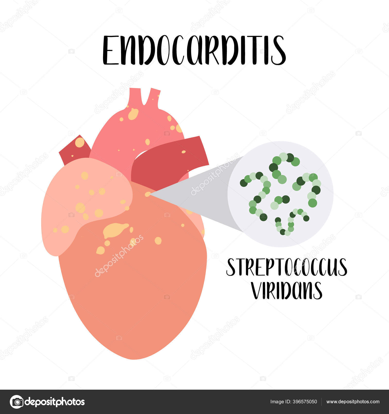 Endocarditis Inflammation Heart Endocardium Streptococcus Viridans ...