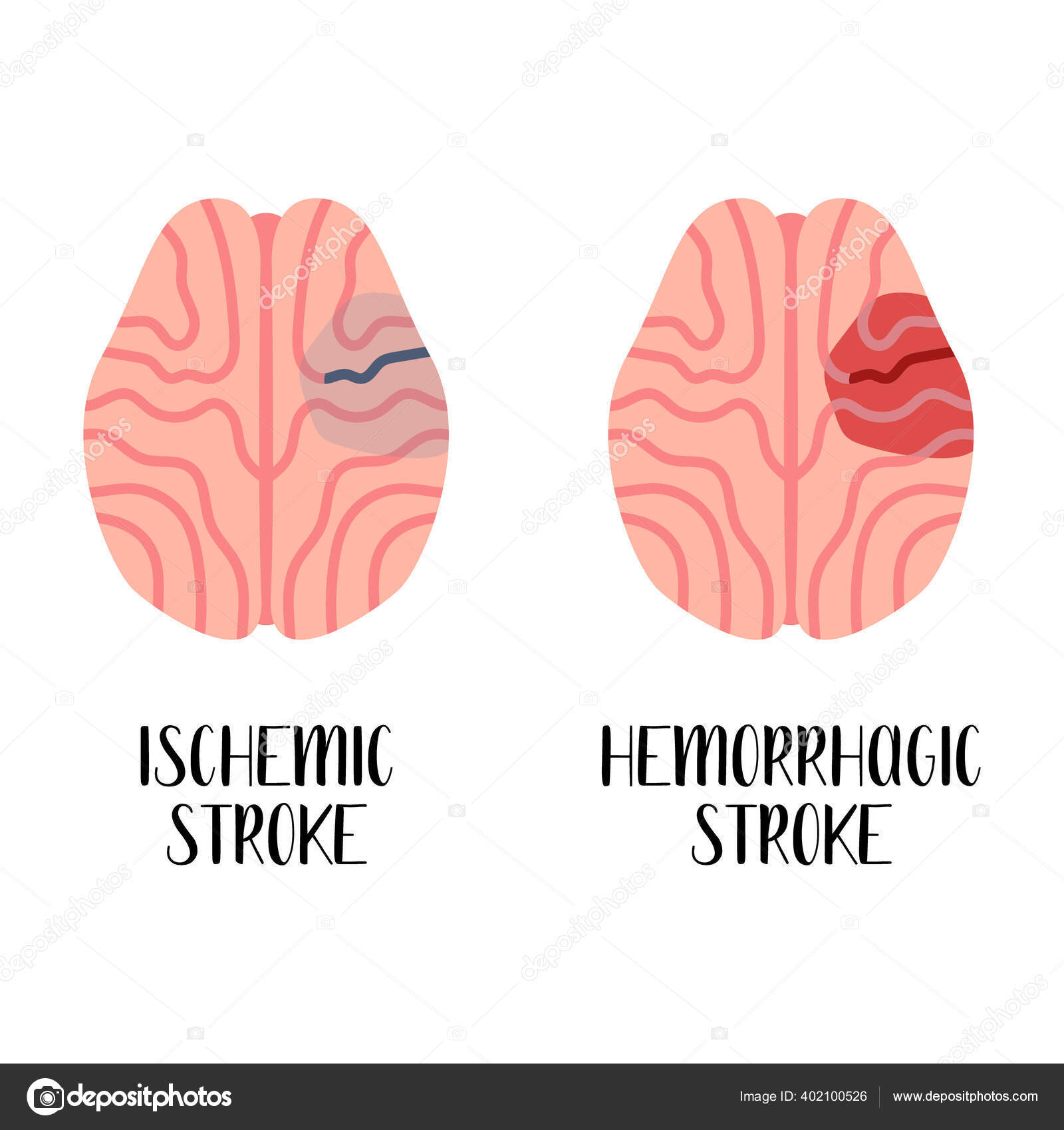Ischemic Hemorrhagic Stroke Brain Diseases Neurobiology Vector Flat Illustration Perfect Stock ...