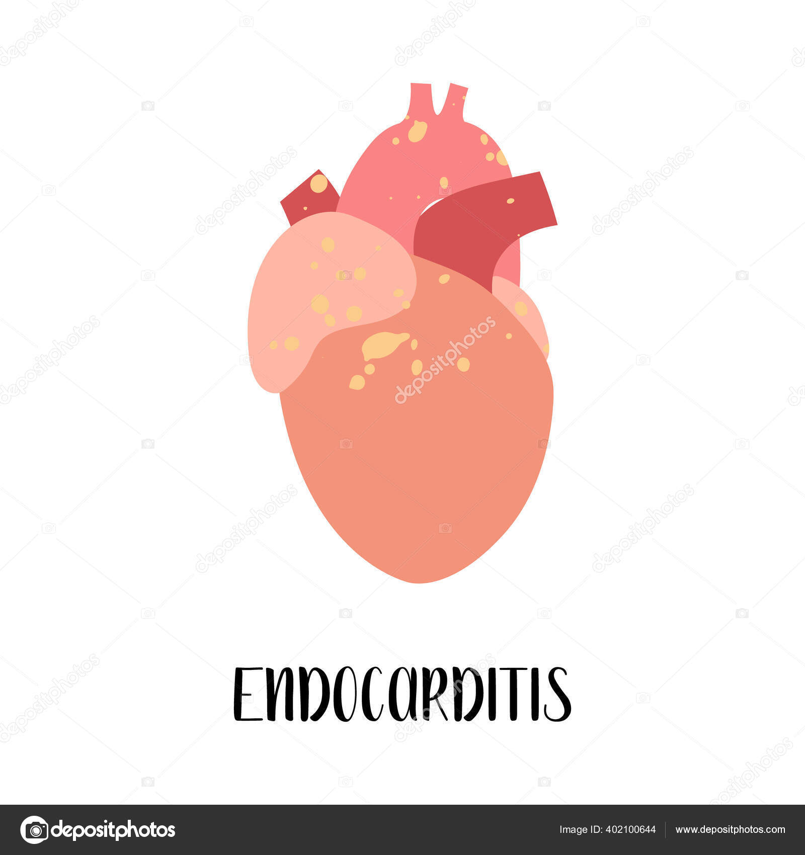 Endocarditis Heart Cardiovascular Disease Cardiology Vector Flat ...
