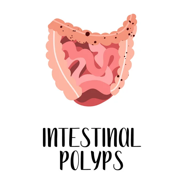 38 Intestinal polyp Vector Images | Depositphotos