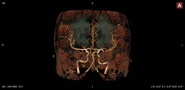 Magnetic Resonance Angiography (MRA) of Brain/3D TOF Maximum Intensity ...