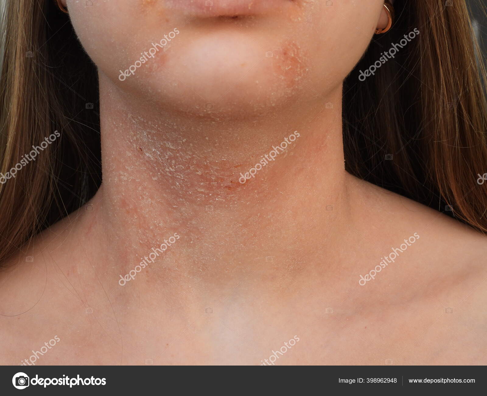 Atopic Dermatitis Stage Exacerbation Region Anterior Surface Neck ...