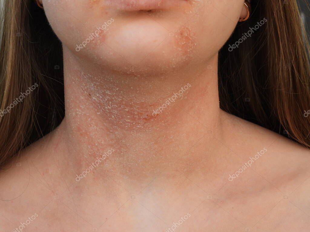 dermatitis atópica en la etapa de exacerbación en la región de la ...