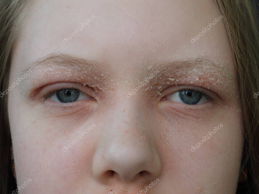 dermatitis atópica en la etapa de exacerbación en el área de los ojos ...