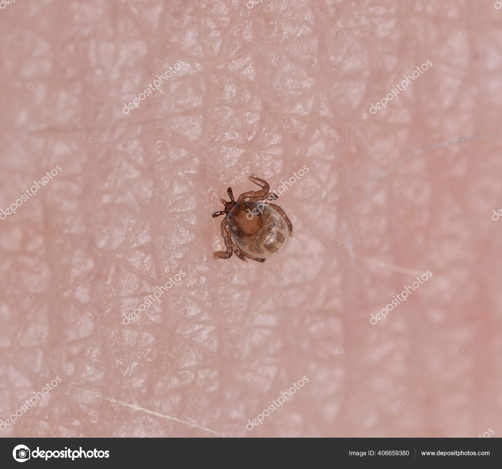 Castor Beam Tick Ixodes Ricinus Nymph Feeding Human Photographed High ...