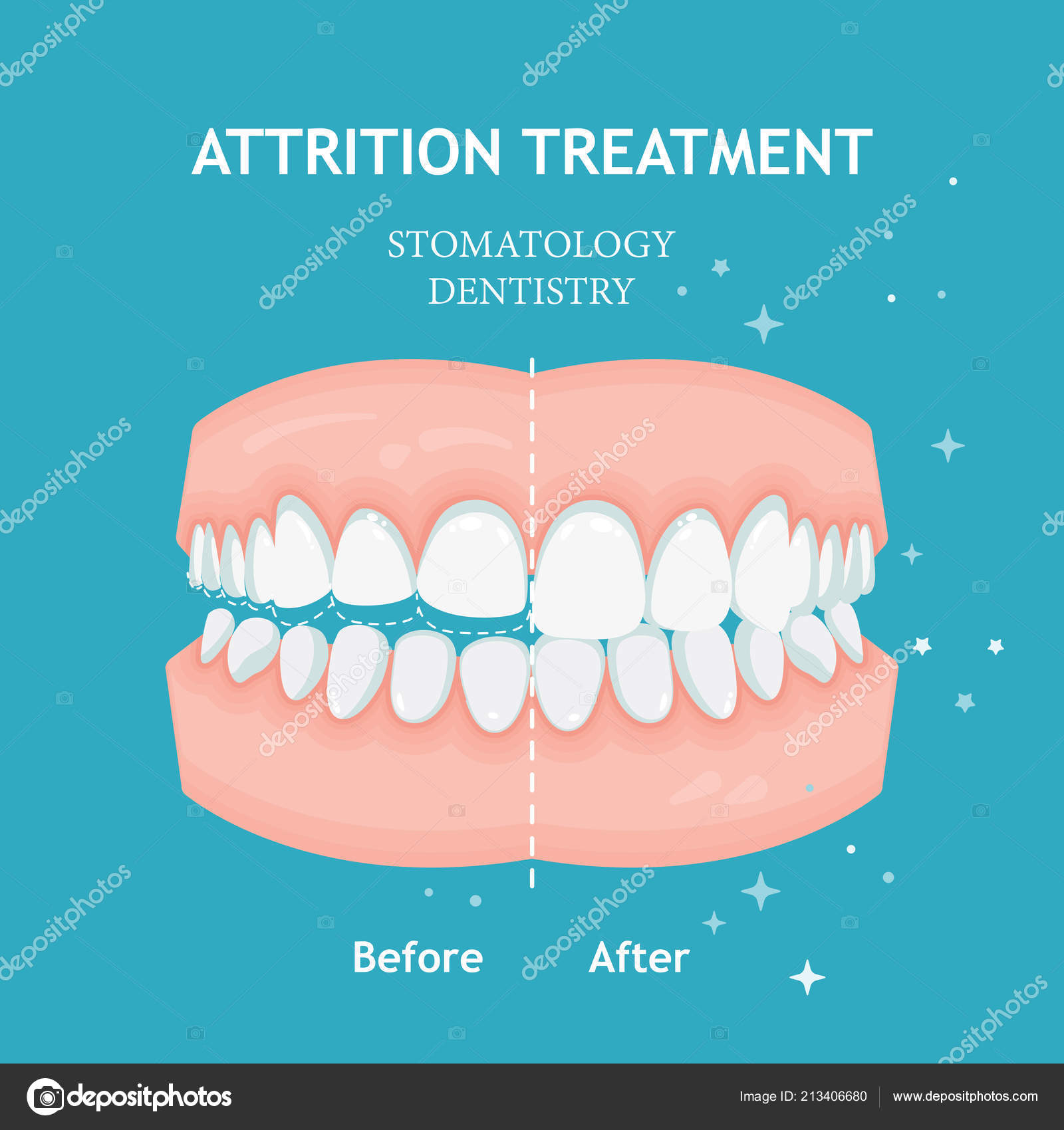 Attrition Treatment Vector Stomatology Dentistry Concept — Stock Vector ...