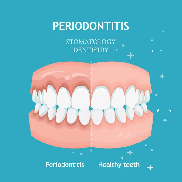 441 Periodontitis Vector Images, Periodontitis Illustrations ...