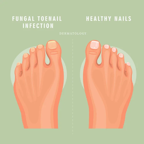 85 Toenail fungus Vector Images, Toenail fungus Illustrations ...