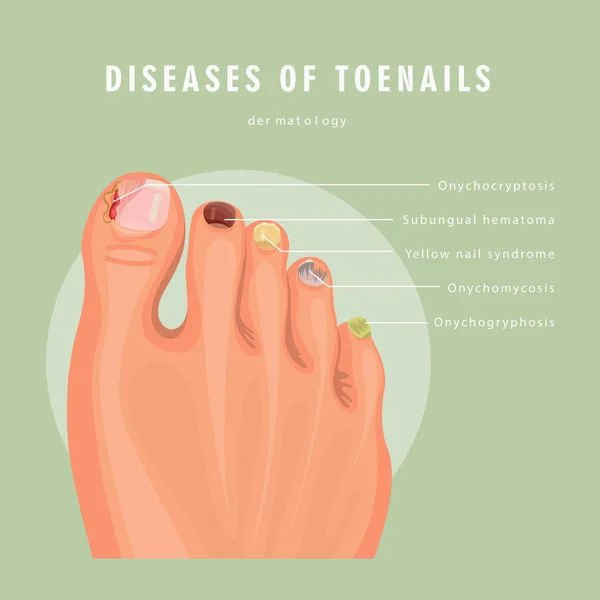 85 Toenail fungus Vector Images, Toenail fungus Illustrations ...