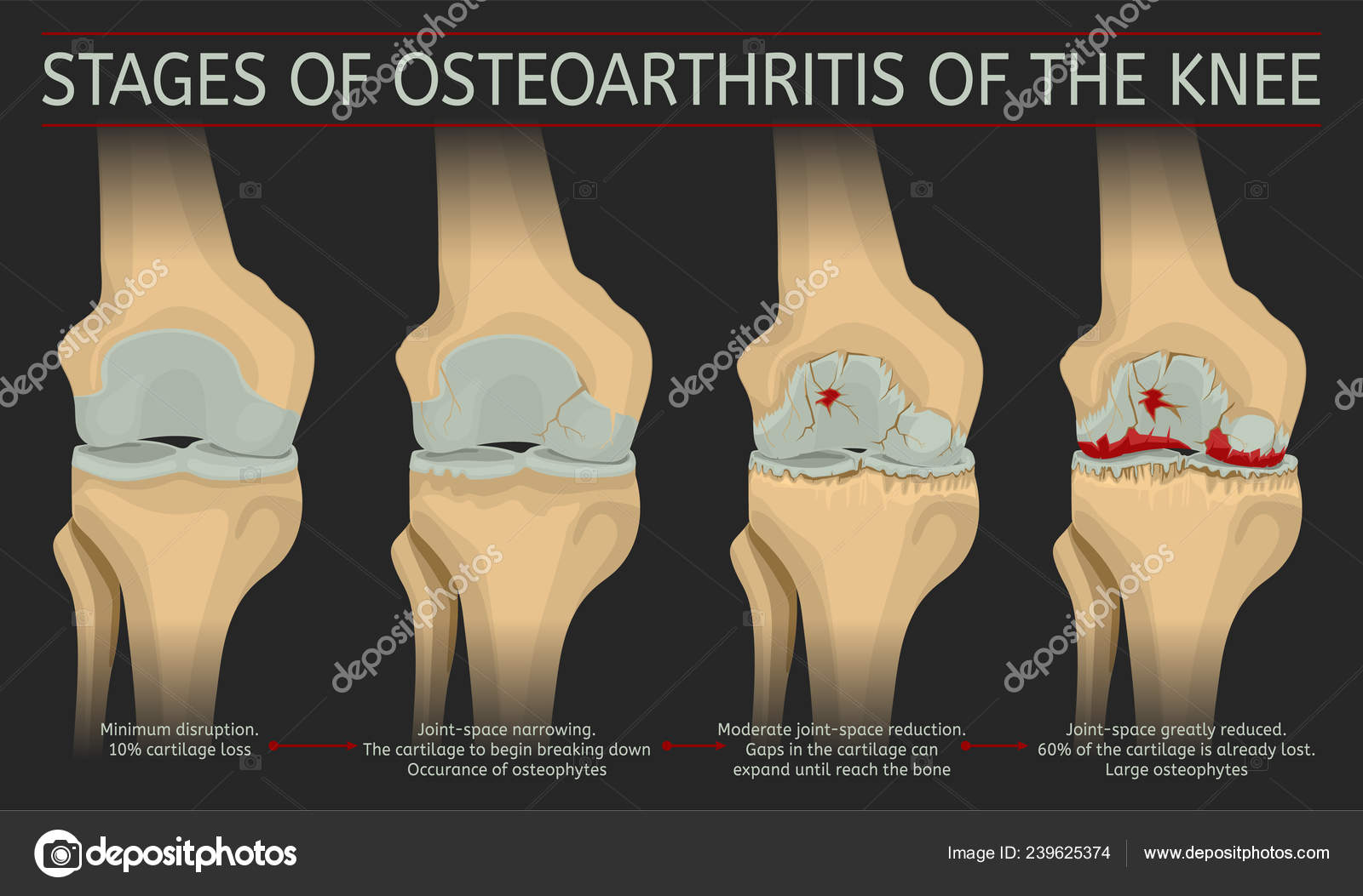 Stades de l'arthrose du genou image vectorielle par annyart ...