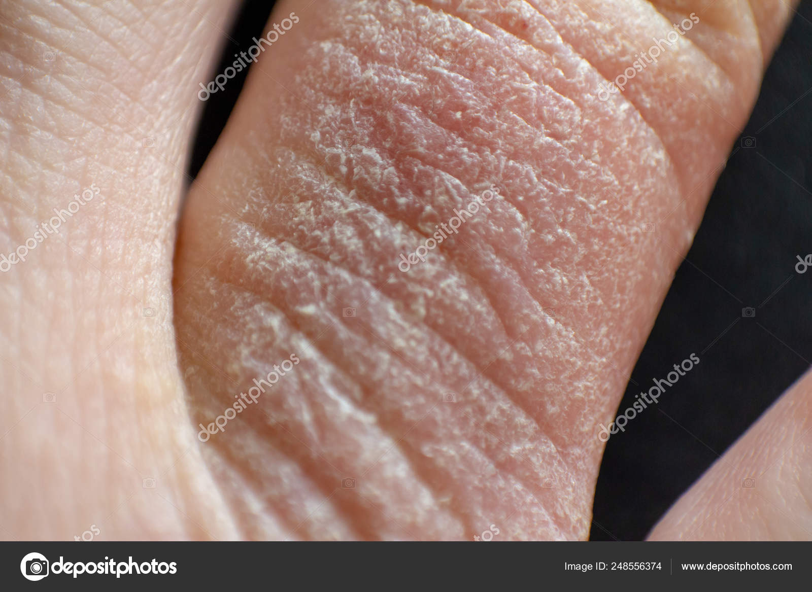 Dermatitis de manos. Eczema del dedo: fotografía de stock © d19p76 ...