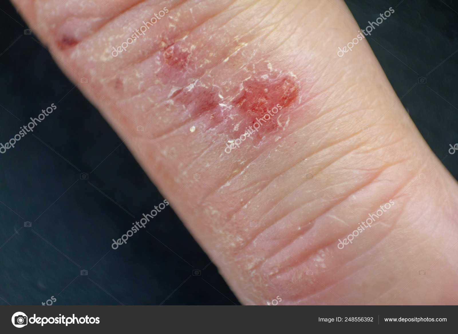 Hand dermatitis. Finger eczema Stock Photo by ©d19p76 248556392