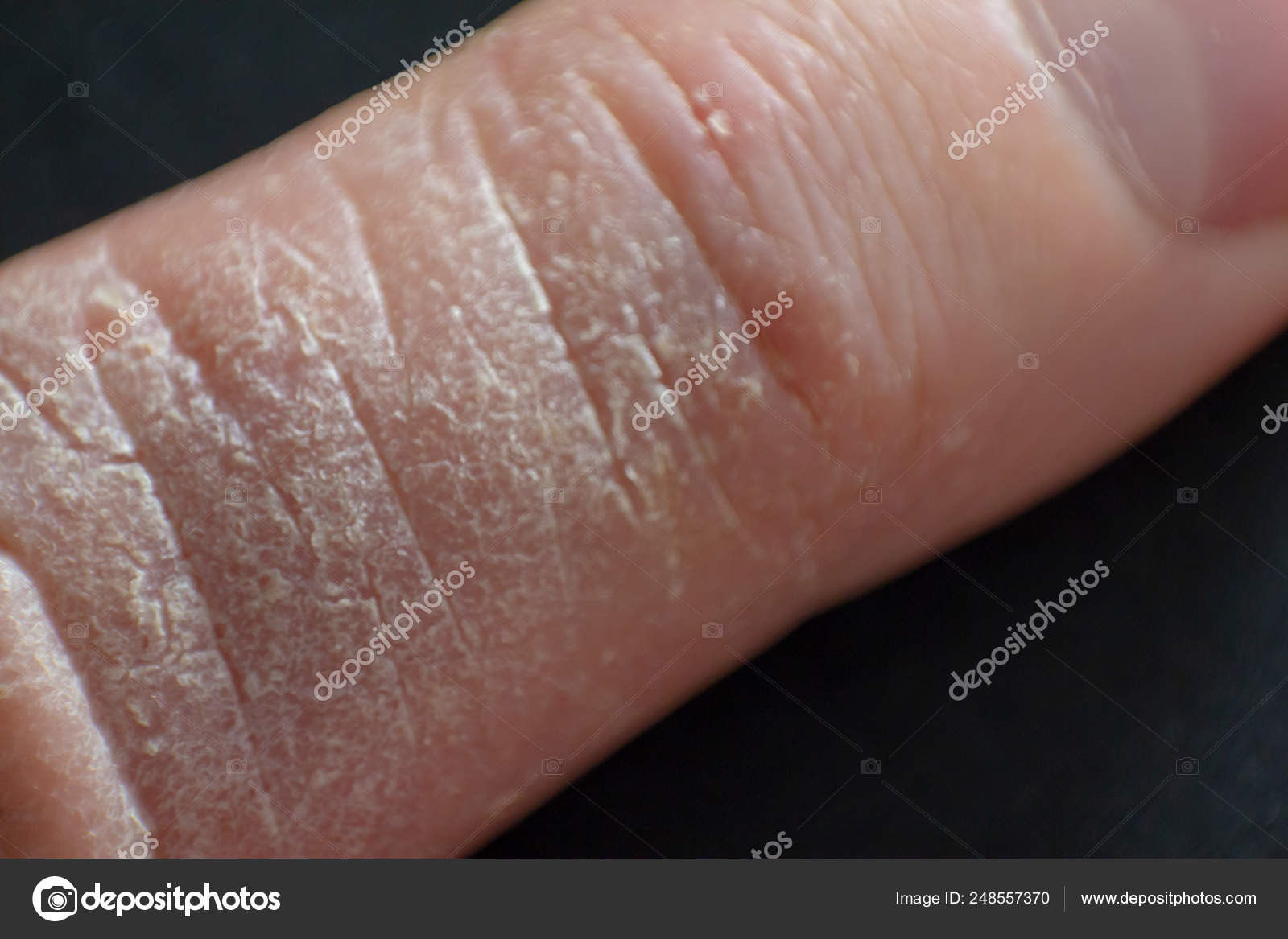 Dermatite de la main. Eczéma des doigts image libre de droit par d19p76 ...