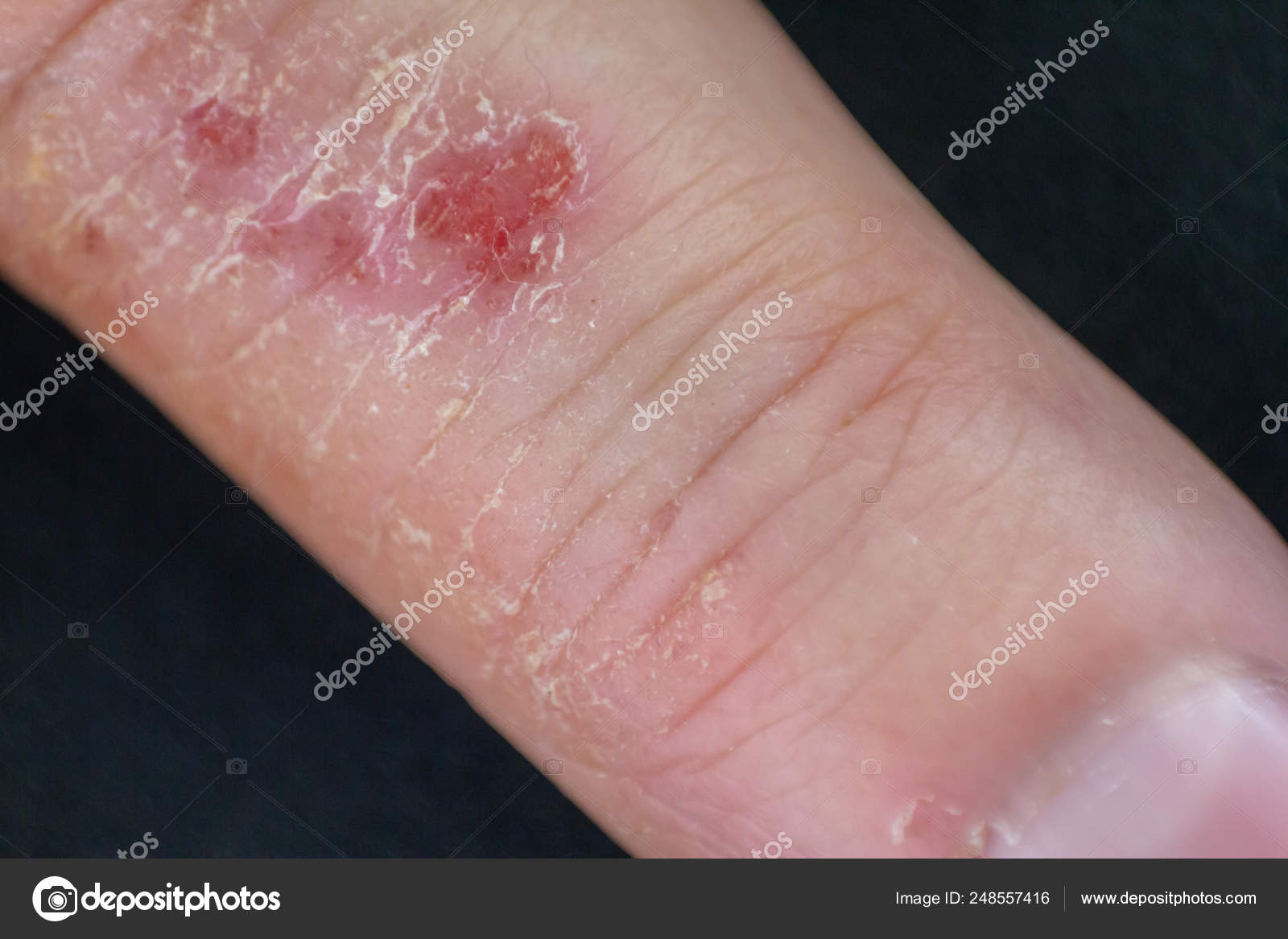 Fingertip Dermatitis