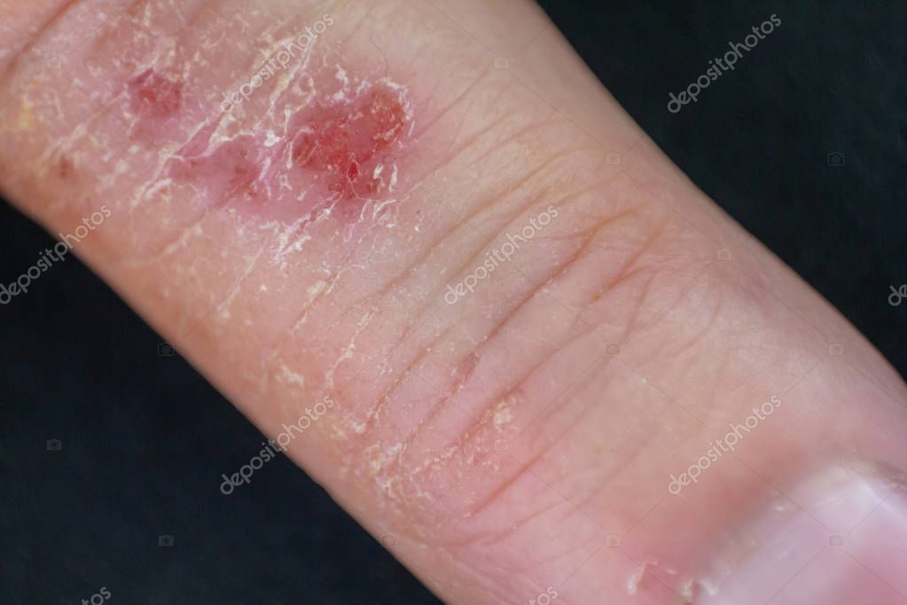 Dermatitis de manos. Eczema del dedo 2025
