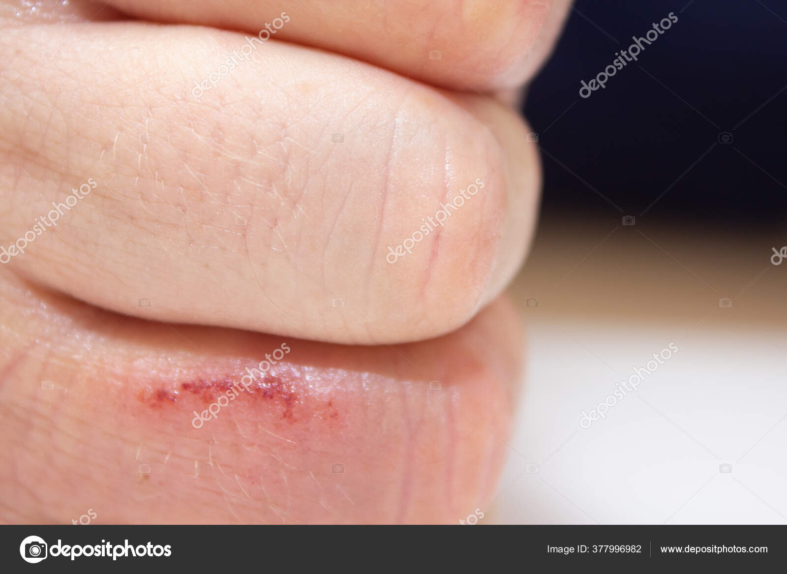 Dermatitis Herpetiformis Hands