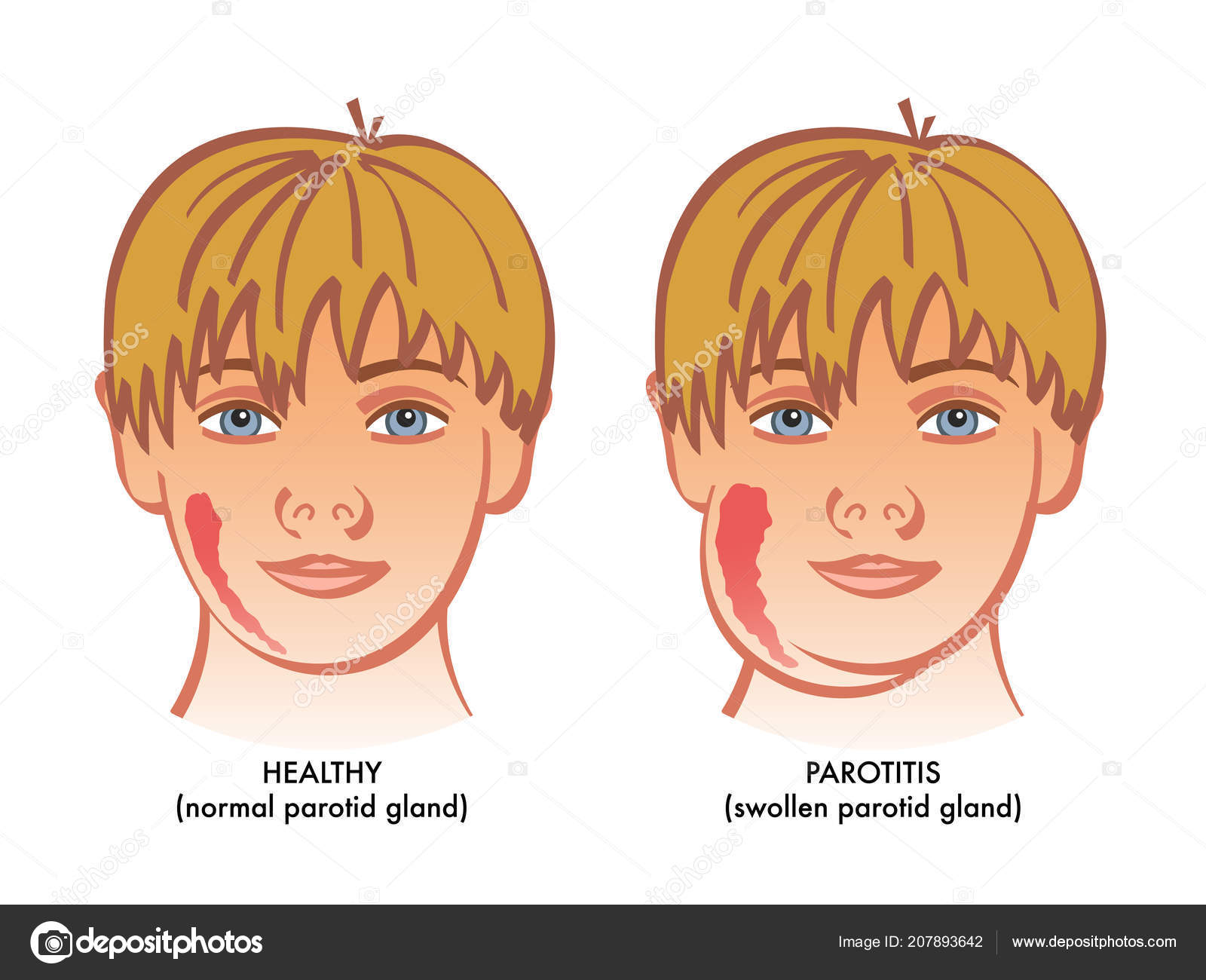 Parotitis Medical Poster White Background Stock Vector Image by ...