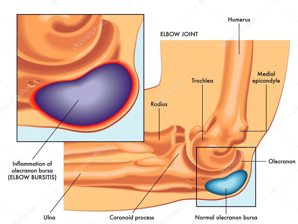 Ilustración médica de los síntomas de bursitis de codo con anotaciones. 2025