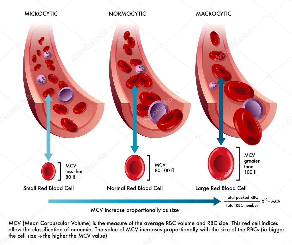 La ilustración médica muestra la diferencia entre un glóbulo rojo ...