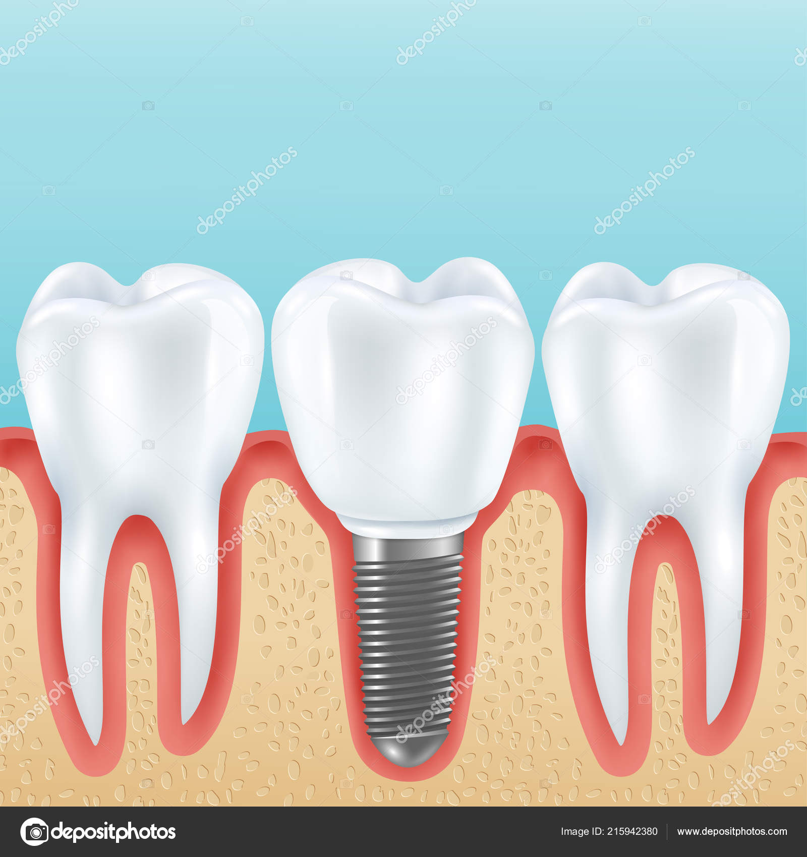 Dental implant realistic illustration Stock Vector by ©macrovector ...