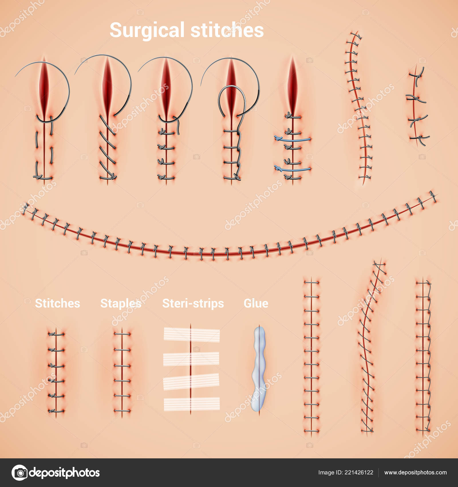 7 Ideas De Sutura Enfermeria Quirurgica Tipos De Suturas Quirurgica Images