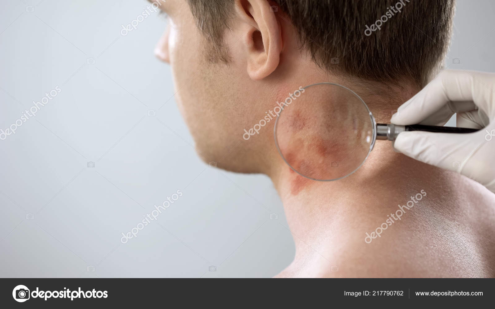 Therapist Examines Rash Patient Neck Magnifying Glass Dermatology Stock ...