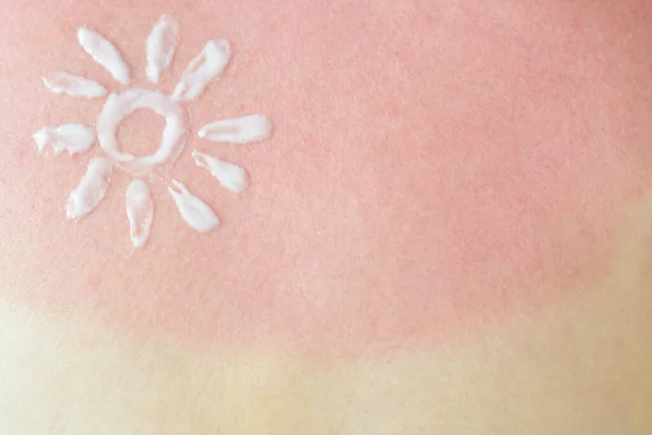 Skin burn Stock Photos, Royalty Free Skin burn Images | Depositphotos