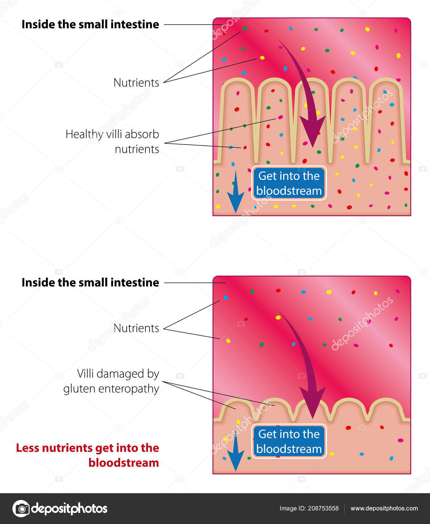 Absorption Nutrients Small Intestine Healthy Damaged Villi Medical ...