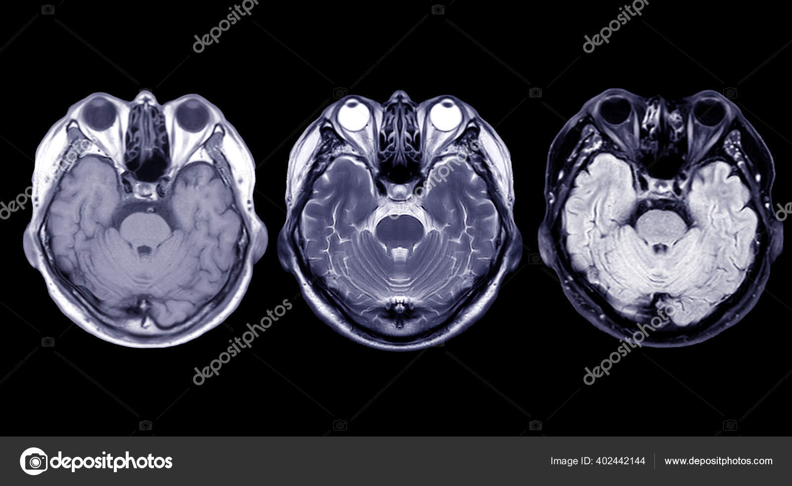 Axial Brain Mri