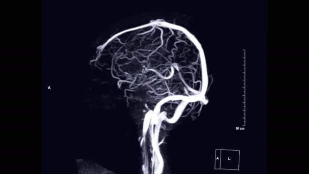 Mrv Brain Magnetic Resonance Venography Brain Mip View Turn Screen ⬇ ...