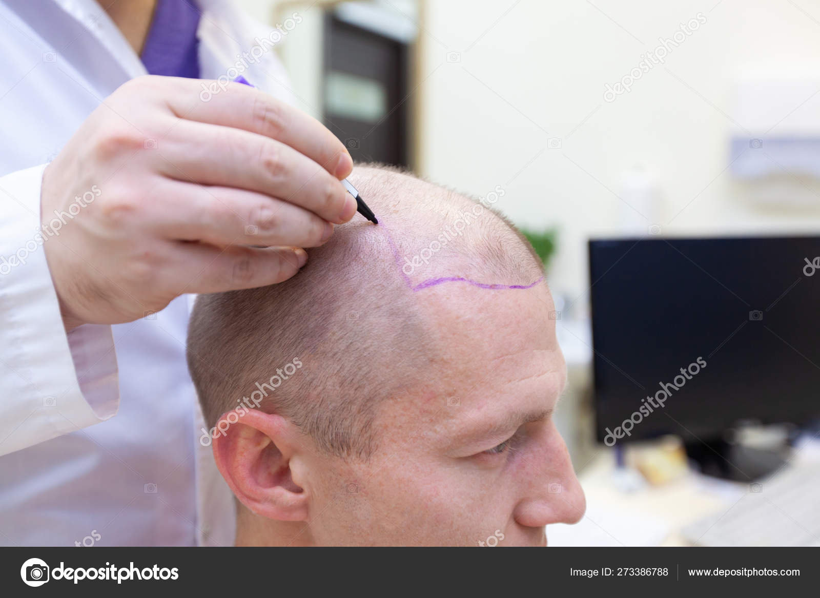 Baldness treatment. Patient suffering from hair loss in consultation ...