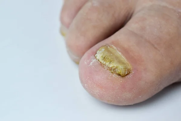 Deformed toenails Stock Photos, Royalty Free Deformed toenails Images ...