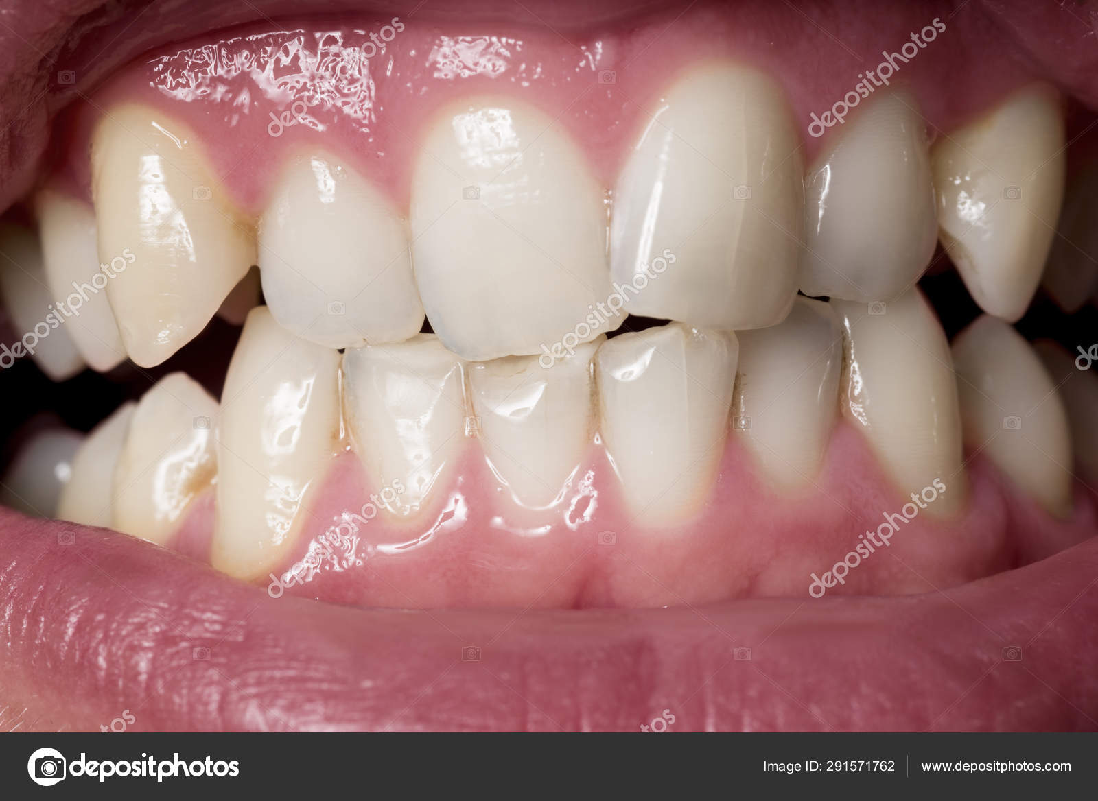 Close up shot of human uneven teeth with some tartar. Stock Photo by ...