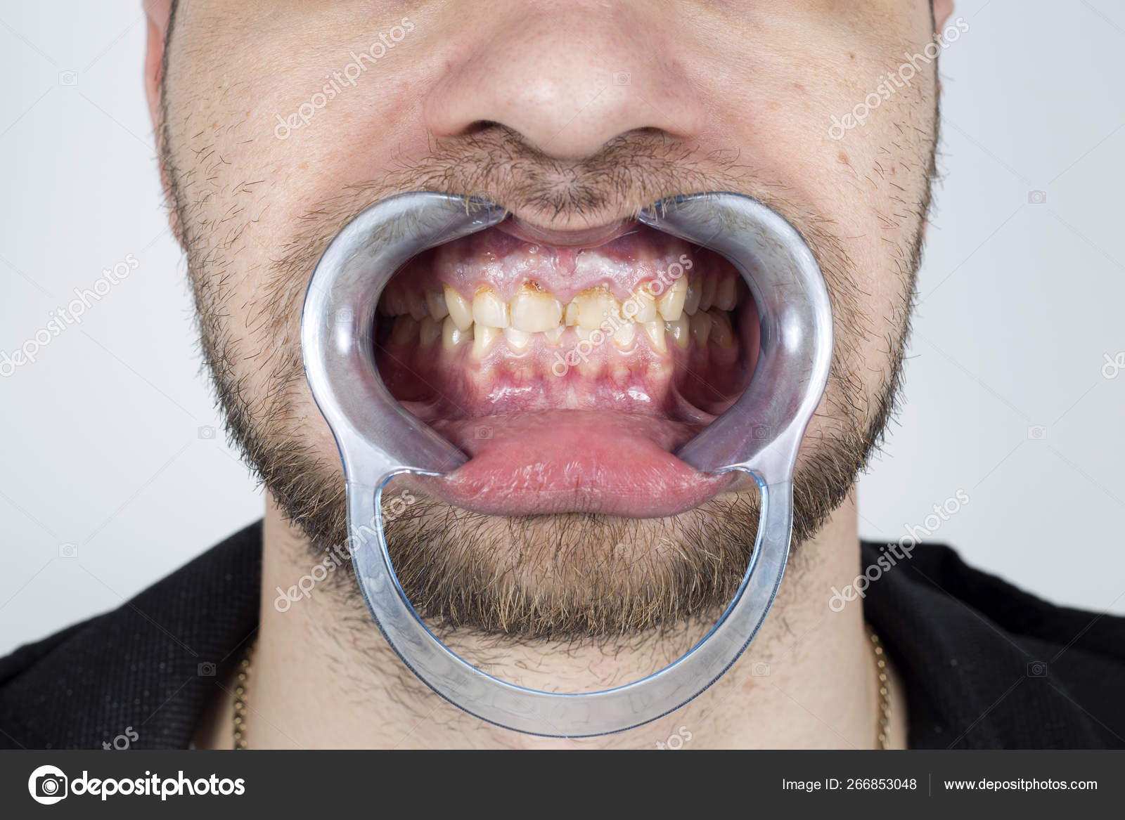 Frontal View Human Jaw Overbite Dental Occlusion Stock Photo by ...