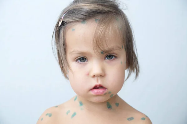 Waterpox Stock Photos, Royalty Free Waterpox Images | Depositphotos®